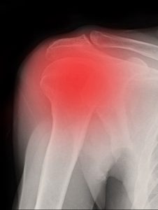 Frozen Shoulder | Dr. Bartholomew | Shoulder Surgeon in Michigan