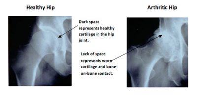Hip Resurfacing | Bone and Joint Specialists | Michigan Hip Expert